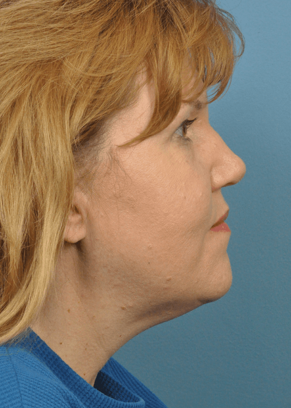 Neck Lift Before and After Pictures Jacksonville, Ponte Vedra Beach