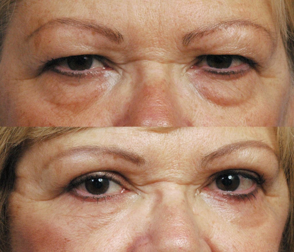 Perk Up Your Look (And Spirits!) With An Eye Lift - Garcia Institute