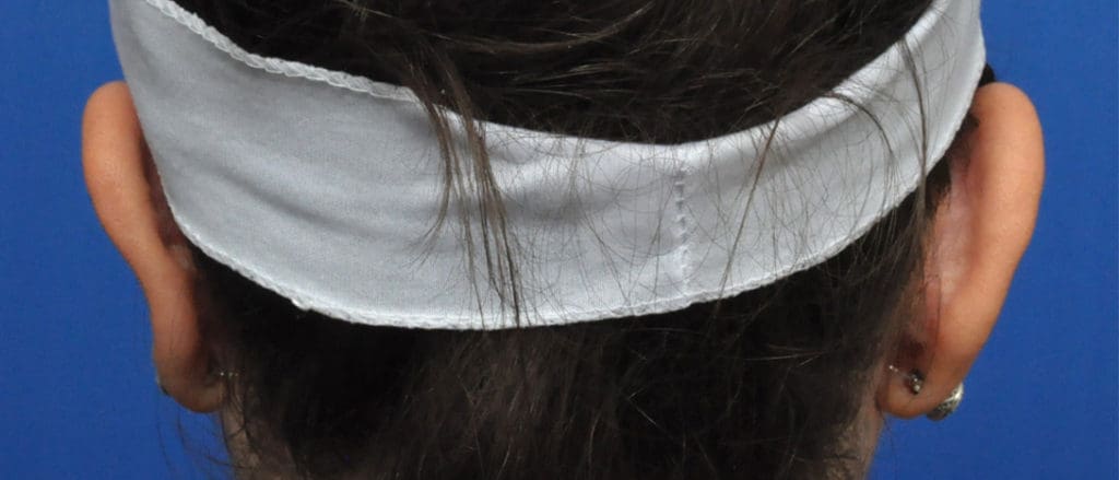 Otoplasty Before and After Pictures Jacksonville, Ponte Vedra Beach